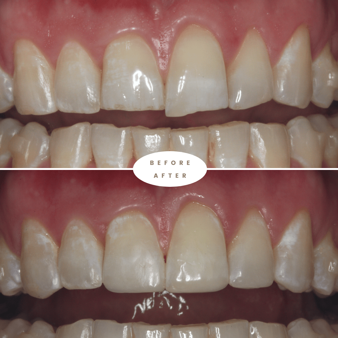 Composite Bonding in Sydney | Composite & Dental Bonding