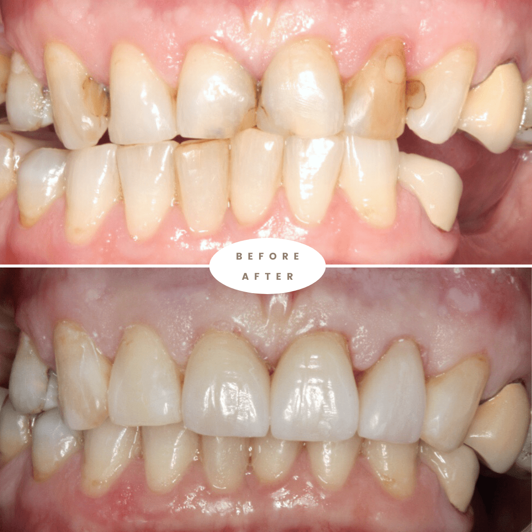 Composite Bonding in Sydney | Composite & Dental Bonding