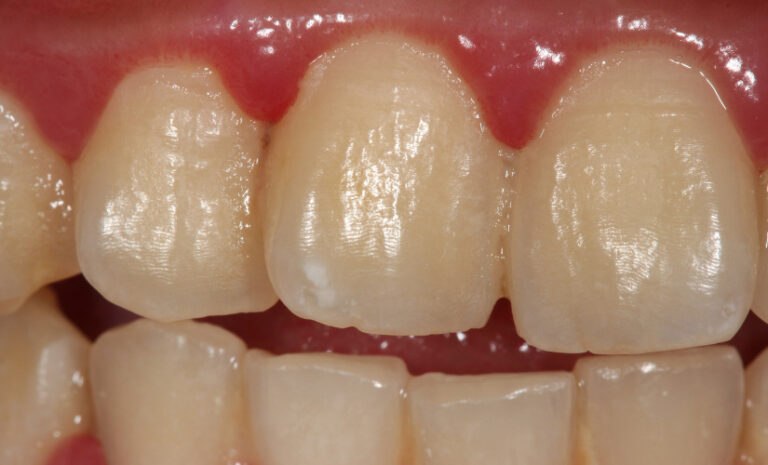 Why do I have Bleeding Gums – Is it Normal?