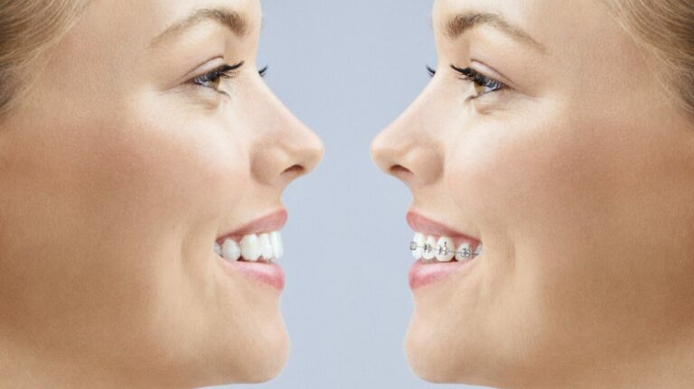 Why do I have Bleeding Gums – Is it Normal?